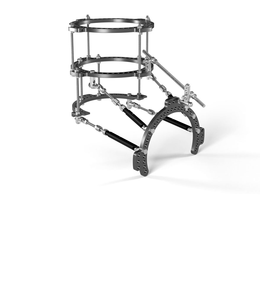 GLW Medical Receives FDA 510(k) Clearance for FusionFrame™ Ring Lock ...