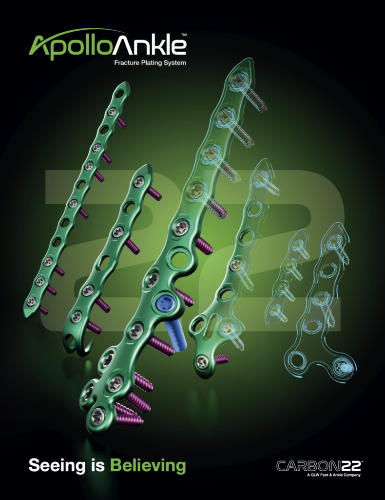 Apollo Ankle™ Fracture Plating System - GLW Medical Innovation